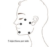 Exploring The BAP Technique | Blog | Fox Pharma
