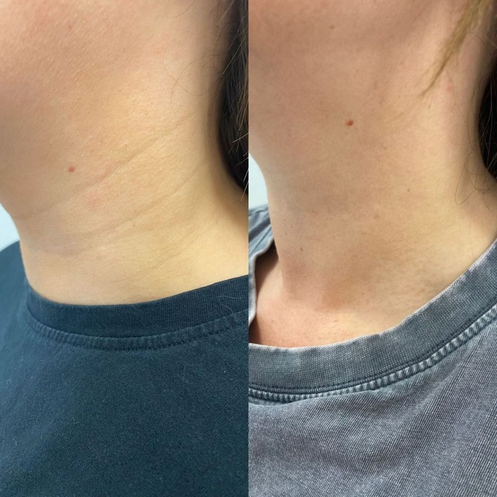 Seventy Hyal Reviews: Neck and Hand Rejuvenation | Fox Pharma