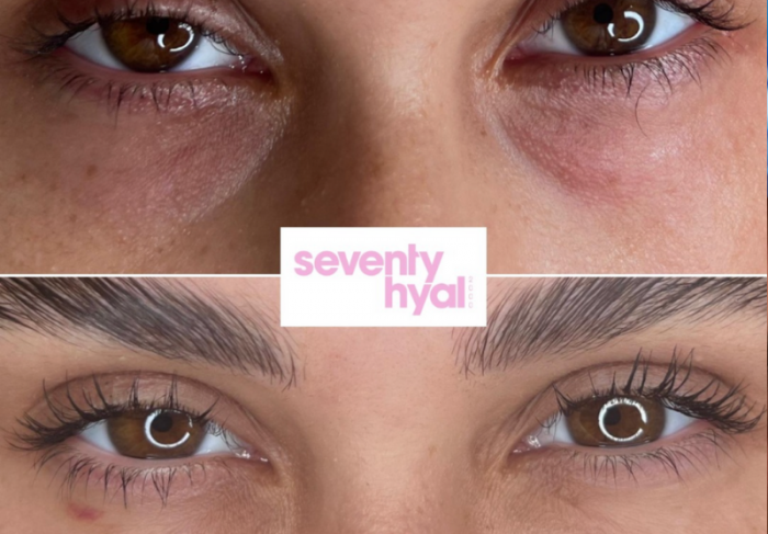 Seventy Hyal 2000 Tear Trough Training | Fox Pharma